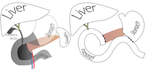 Pancreatic Resection - Cutting Edge Surgical Associates